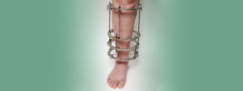 Custom AFO Braces for complex ankle deformities